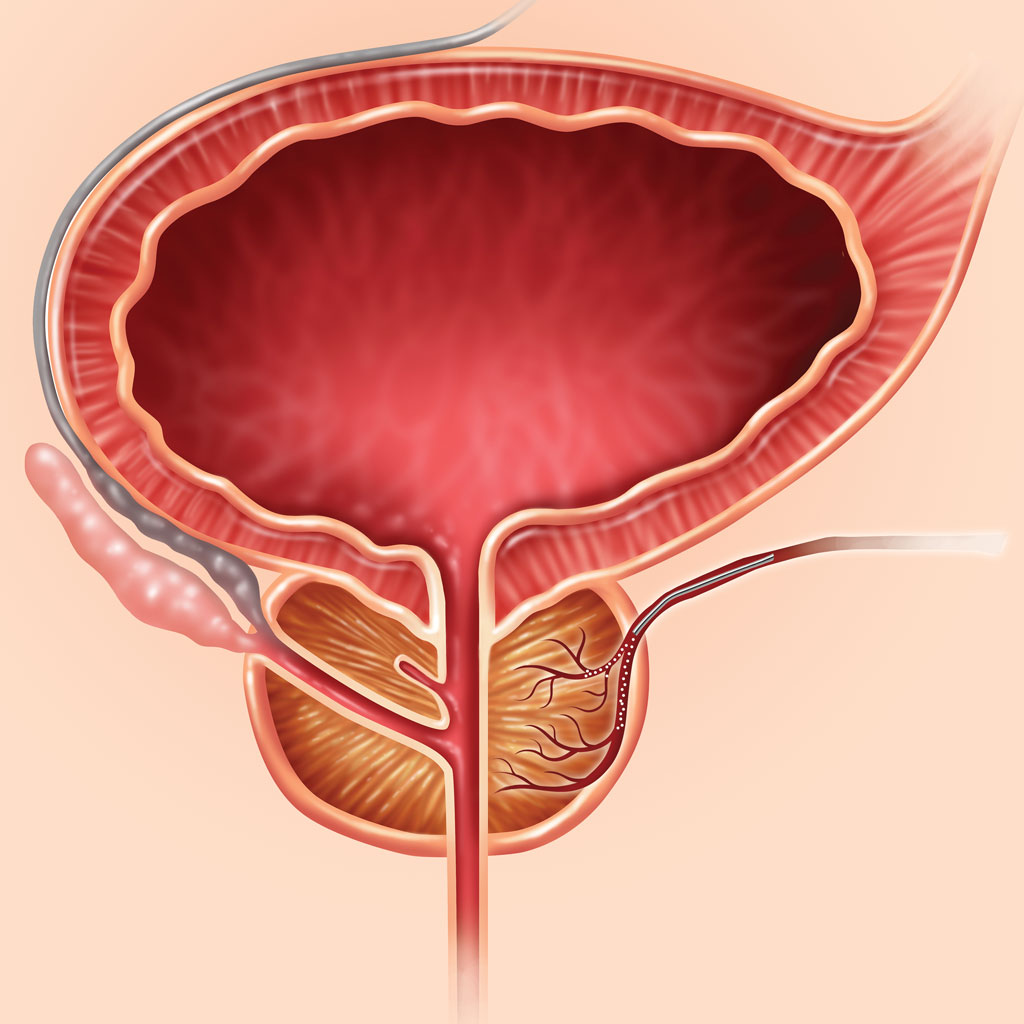 What You Should Know About Prostate Artery Embolization Pae Memphis Vascular Center